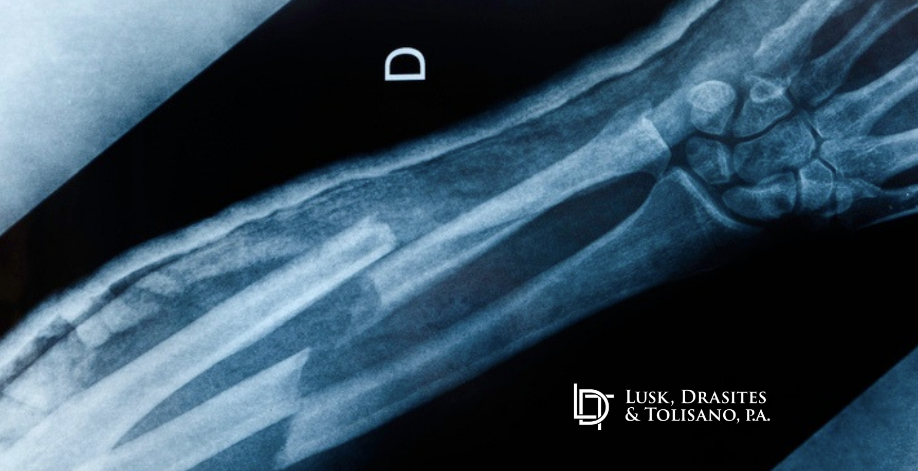 What Is The Compensation for Broken Bones & Fractures?